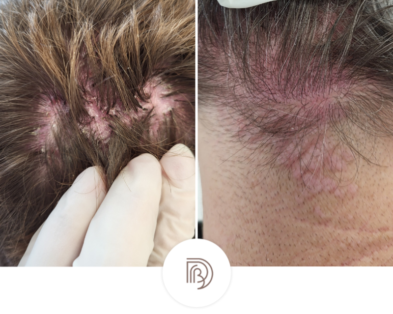 Seboroická dermatitida (Seborea) ve vlasech - jak ji úspěšně vyléčit